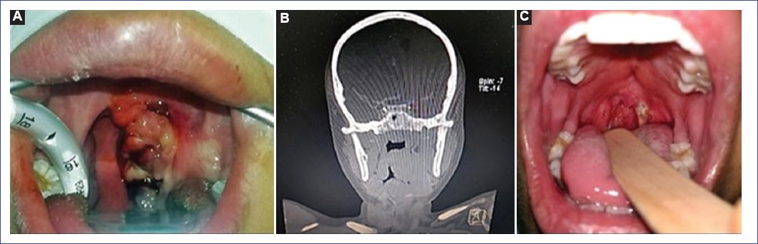 Tonsillar Hypertrophy
