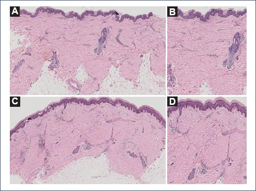 Hyperpigmented lesions with acquired atrophy following Blaschko lines ...