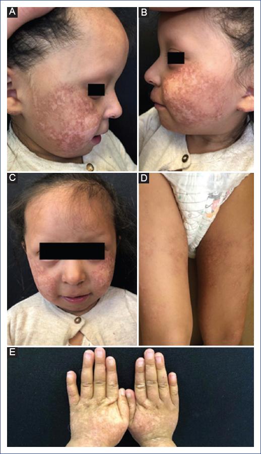 Rothmund-Thomson syndrome: a case series from a tertiary pediatric ...