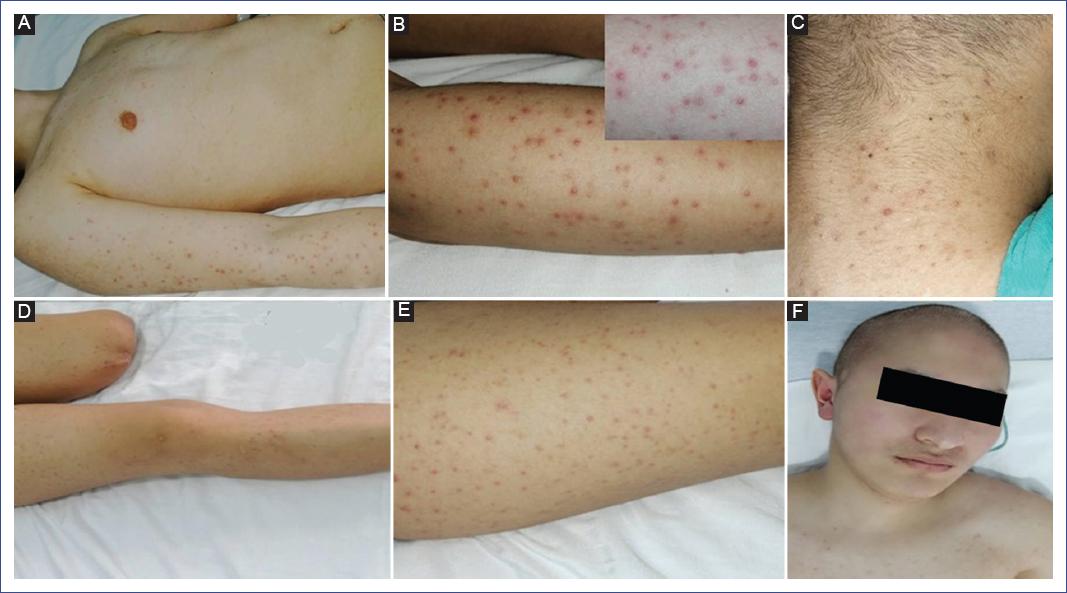Pityrosporum Folliculitis Histology