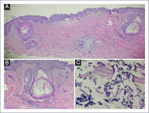 Pityrosporum Folliculitis Histology