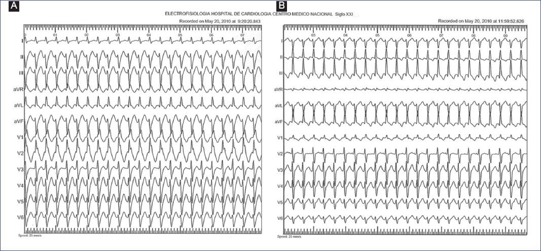 Idiopathic left fascicular ventricular tachycardia in children and ...