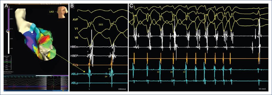 Idiopathic left fascicular ventricular tachycardia in children and ...