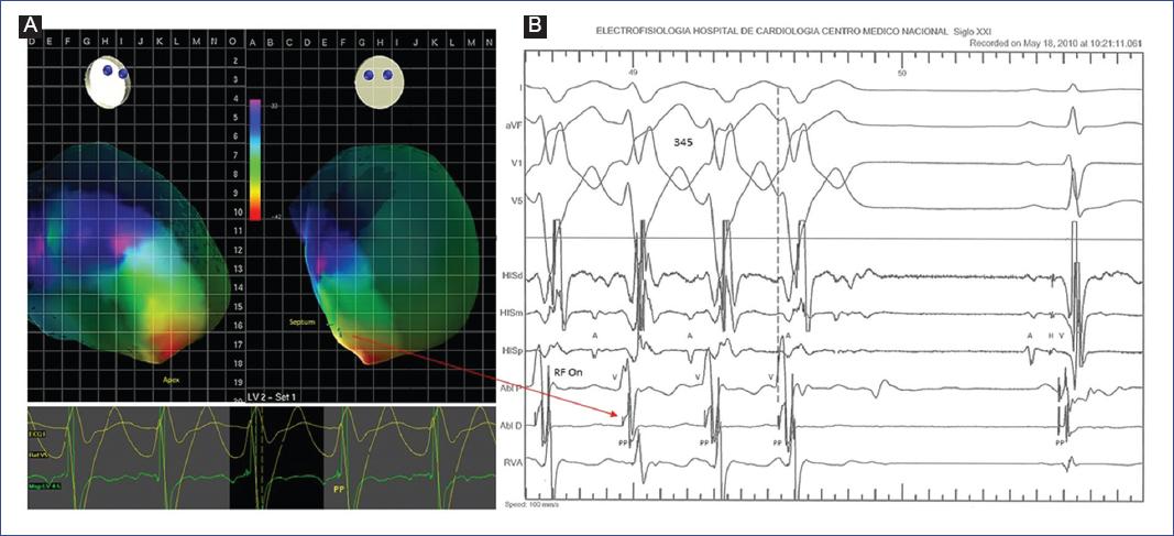Idiopathic left fascicular ventricular tachycardia in children and ...