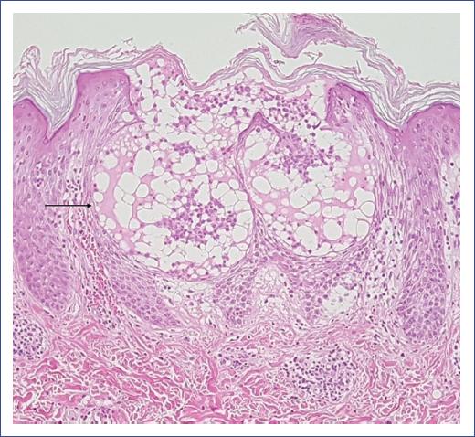 Acute Generalized Exanthematous Pustulosis Histology