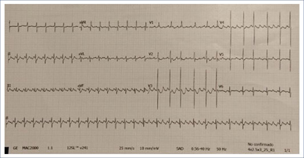 Atrial flutter without structural heart disease in pediatrics: a ...
