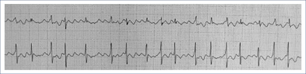 Atrial flutter without structural heart disease in pediatrics: a ...