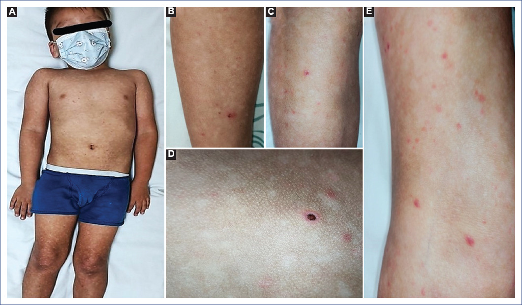 Acute lichenoid and varioliform pityriasis in a pediatric patient