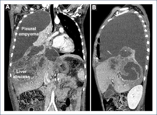 Massive pleural empyema secondary to amoebic liver abscess in a child