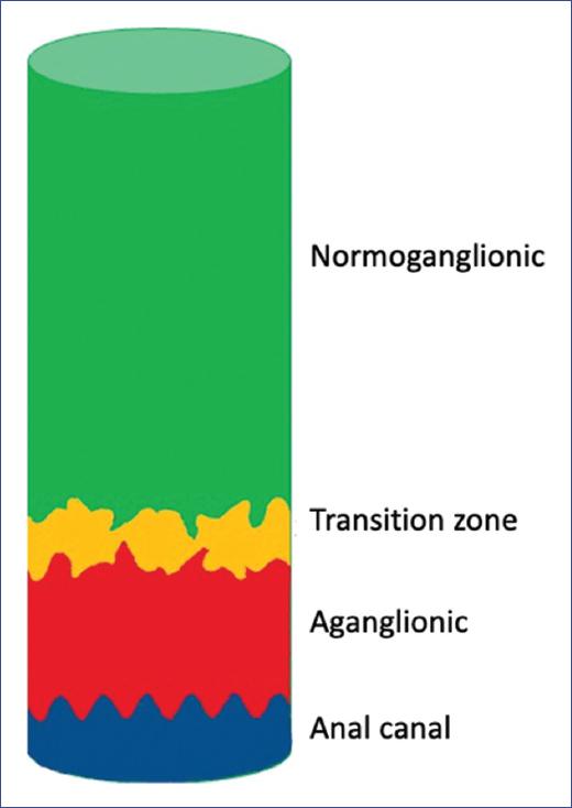 Histological transitional zone pull-through in Hirschsprung disease ...