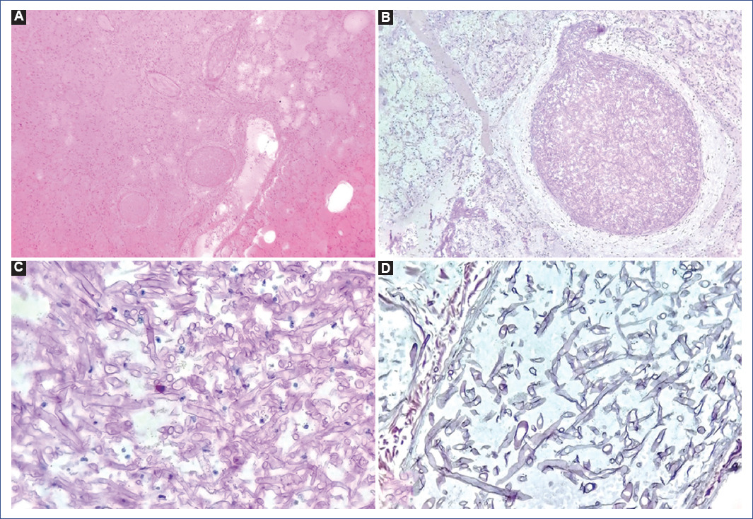 Disseminated mucormycosis in a child with acute lymphoblastic leukemia ...