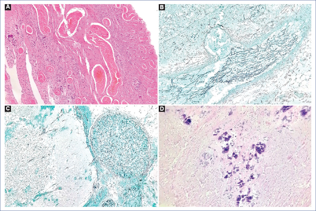Disseminated mucormycosis in a child with acute lymphoblastic leukemia ...