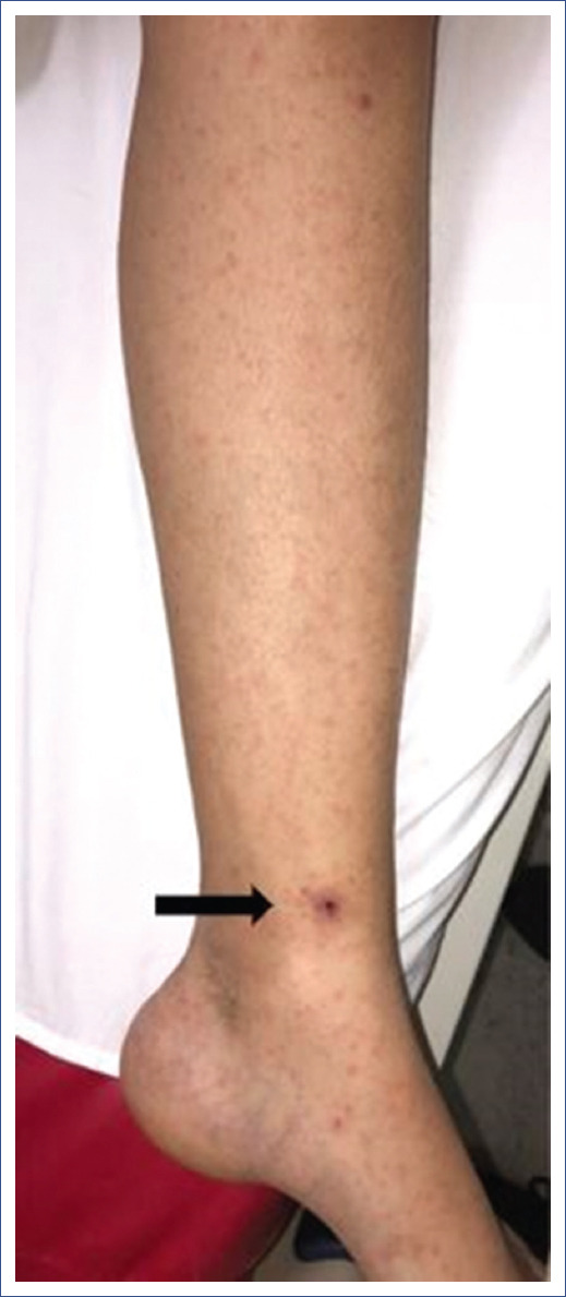 First report of pediatric ehrlichiosis in Mexico