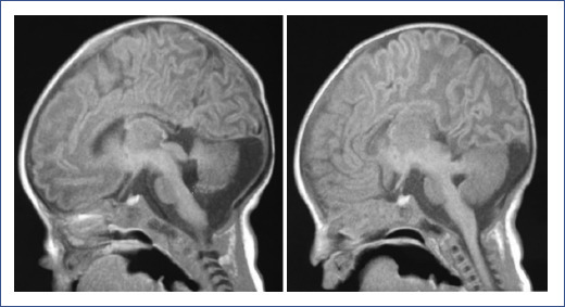 Joubert syndrome: a case report of neonatal presentation and early ...