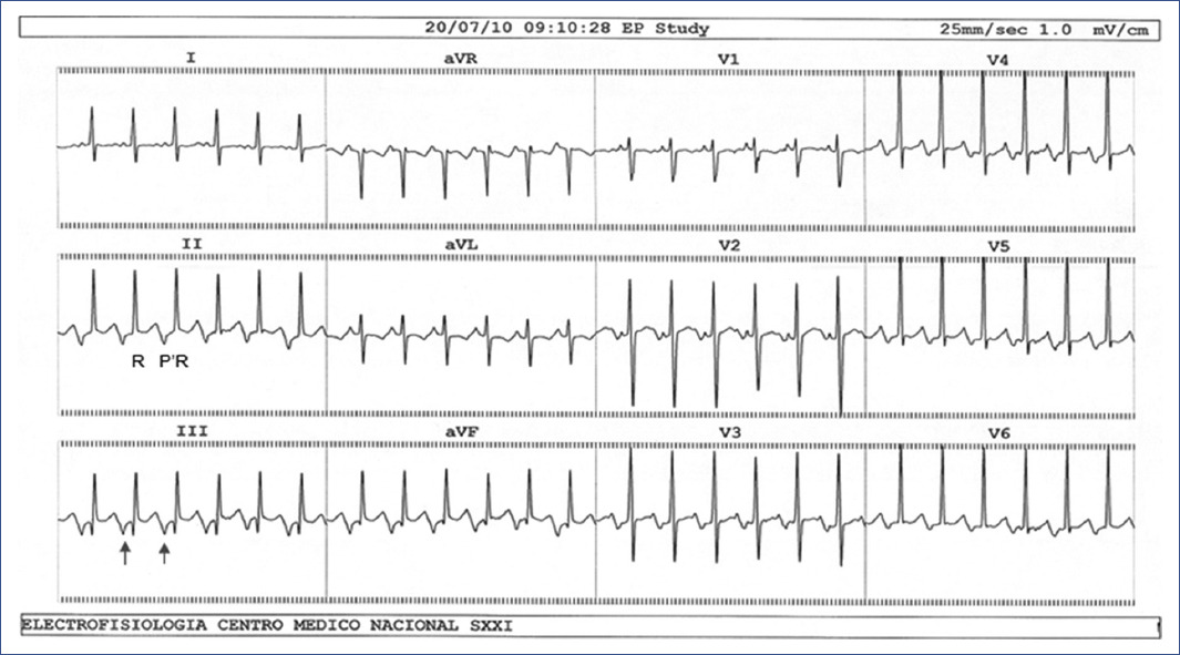 Coumel tachycardia in children