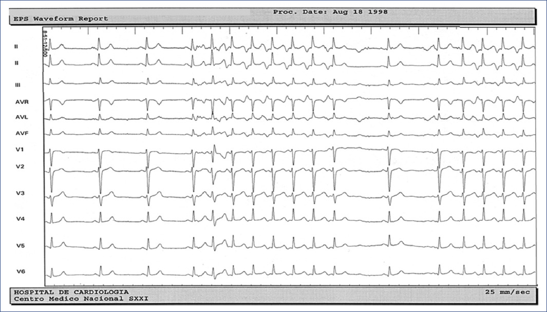 Coumel tachycardia in children