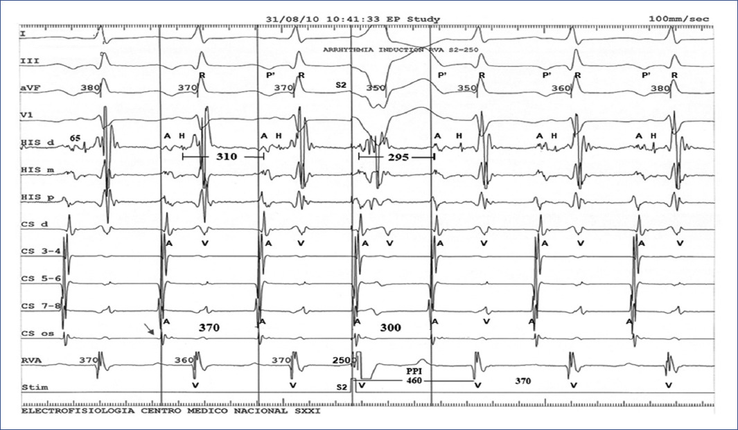Coumel tachycardia in children