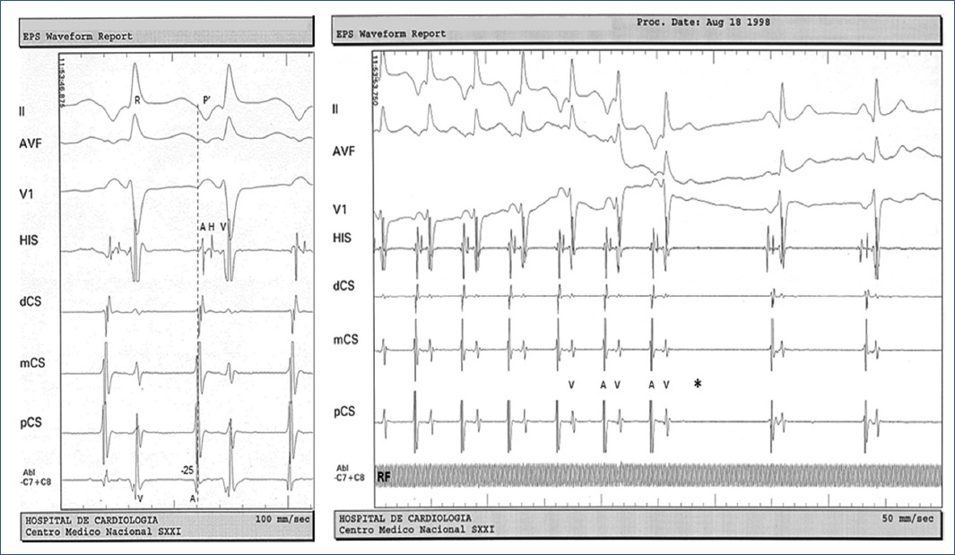 Coumel tachycardia in children