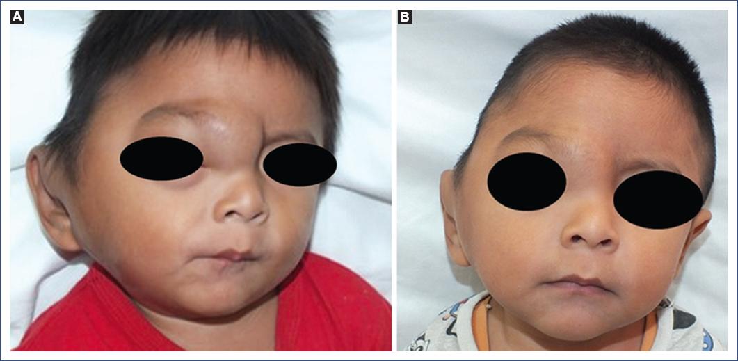 Vascular malformations in pediatric patients: 10-year experience of a ...