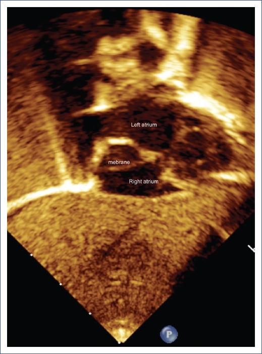 Cor triatriatum dexter: an uncommon cause of neonatal cyanosis