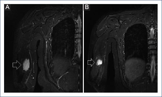 Intramuscular vascular malformations in pediatric patients: a ...