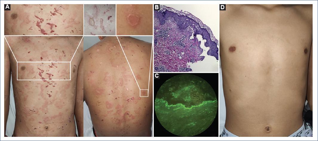Linear IgA bullous dermatosis in a latin adolescent treated with ...