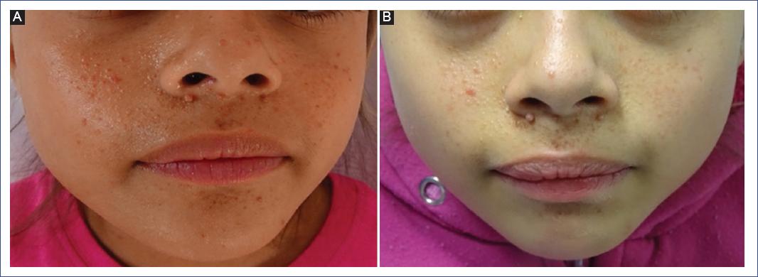 Effectiveness and safety of topical sirolimus in children with ...