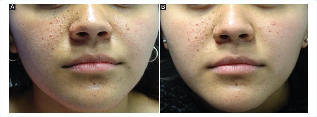 Effectiveness and safety of topical sirolimus in children with ...