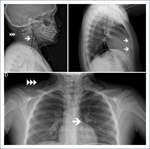 Cough-related spontaneous retropharyngeal emphysema in a pediatric ...