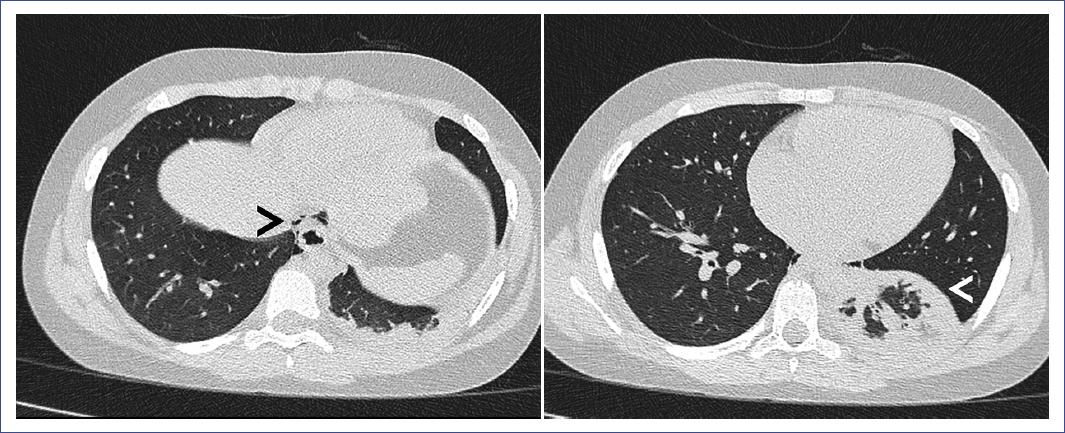 Cough-related spontaneous retropharyngeal emphysema in a pediatric ...