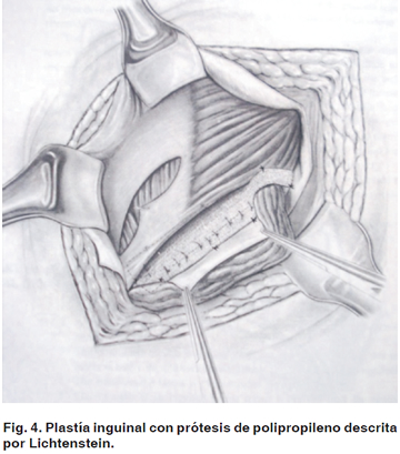 Irving Lichtenstein, maestro de la cirugía inguinal: semblanza de su ...