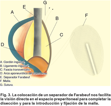 Comparación entre la técnica de malla cupular elíptica (MCE) con la ...