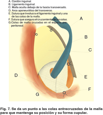 Comparación entre la técnica de malla cupular elíptica (MCE) con la ...