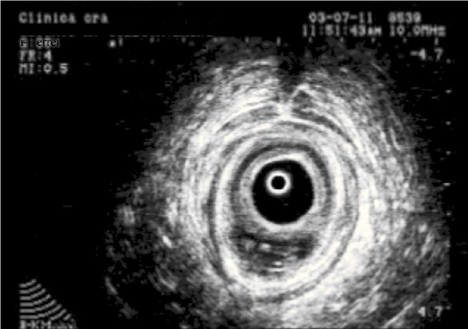 El tipo de absceso anal afecta a la complejidad de la fístula anal