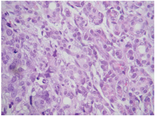 Cáncer pancreático y embarazo