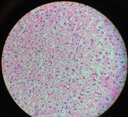 Coristoma hepático, hallazgo en colecistectomía laparoscópica. Reporte ...