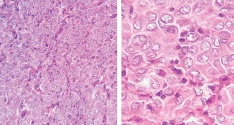 Linfoma no Hodgkin gastrointestinal presentándose como abdomen agudo