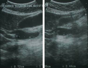Quiste de colédoco