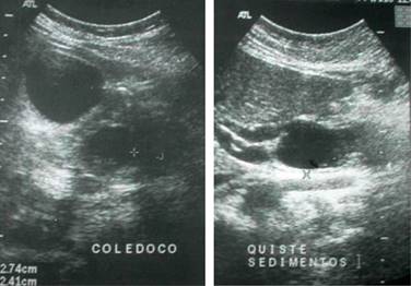 Quiste de colédoco