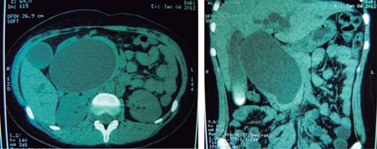 Experiencia en el manejo del quiste de colédoco en un servicio de ...