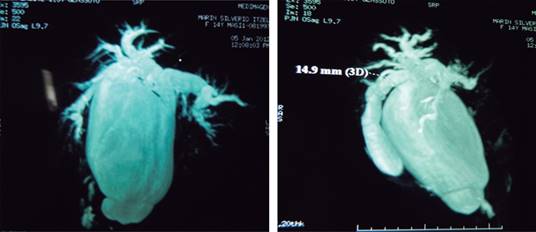 Experiencia en el manejo del quiste de colédoco en un servicio de ...