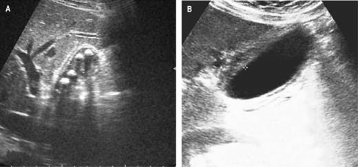 Management of gallbladder edema confused as cholecystitis in the ...