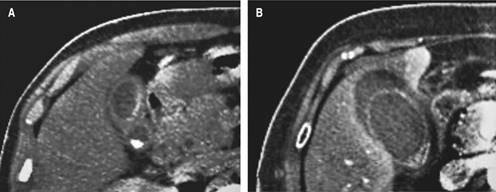 Management of gallbladder edema confused as cholecystitis in the ...