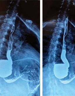 Divertículo esofágico epifrénico