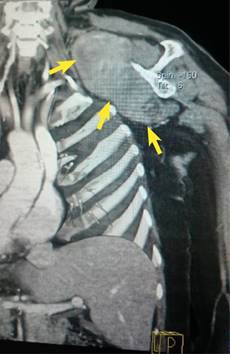 Abordaje quirúrgico y resolución sin prótesis de fibromatosis desmoide ...