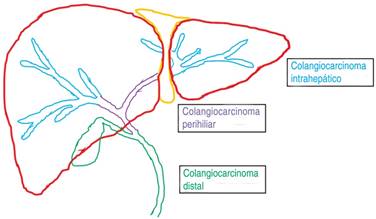 Colangiocarcinoma. Caso clínico a propósito del abordaje diagnóstico