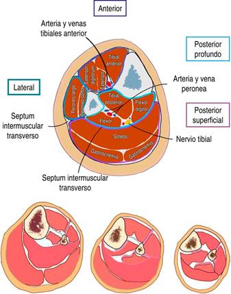 Síndrome compartimental en extremidades