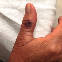 Manejo quirúrgico versus tratamiento médico en loxoscelismo cutáneo ...