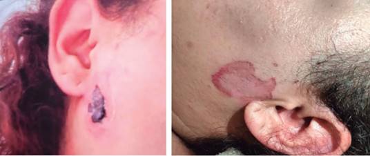 Manejo quirúrgico versus tratamiento médico en loxoscelismo cutáneo ...