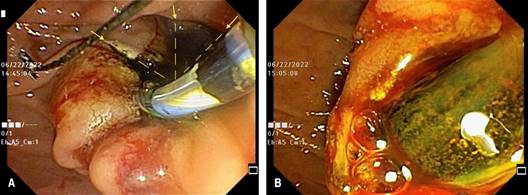 Esfinterotomía radial en colangiopancreatografía retrógrada endoscópica ...